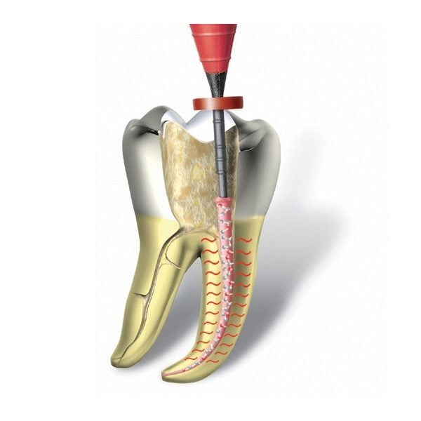 Protaper Wave One Guttacore Sıcak Gutta |DENTSPLY | Açısız ...