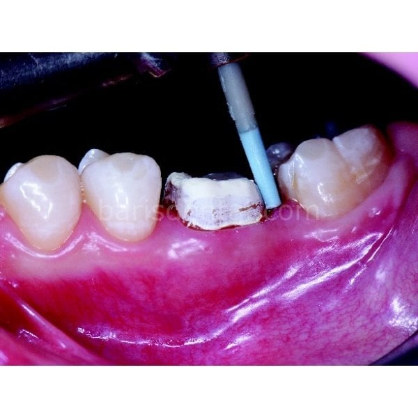 OptiClean Siman Temizleme Frezi (12 ADET) |KERR | Siman Çeşitleri ...