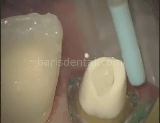 OptiClean Siman Temizleme Frezi (12 ADET) |KERR | Siman Çeşitleri ...